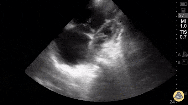 Right Ventricular Dysfunction — TPA