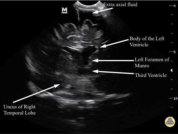 Neonatal Head Ultrasound
