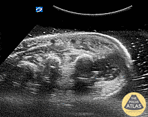 Musculoskeletal — TPA