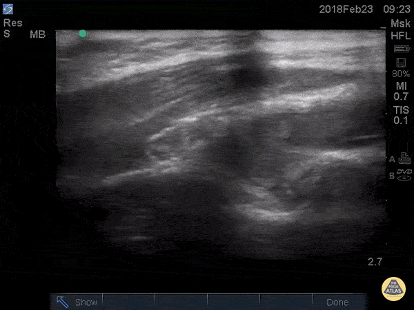 Musculoskeletal — TPA