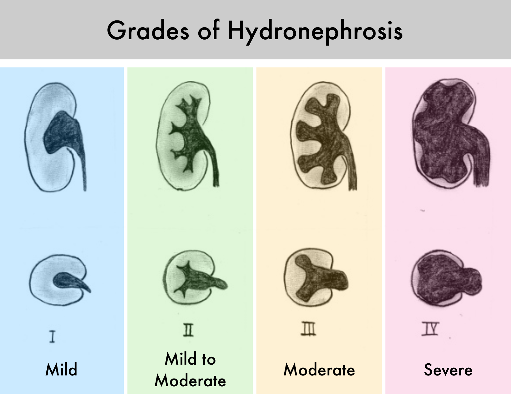 Hydronephrosis — TPA
