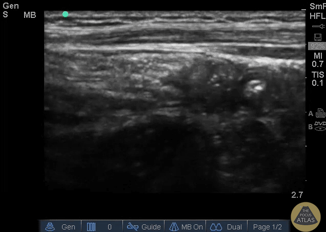 Bedside Ultrasound For Acute Appendicitis - Featuring Colorized Images ...