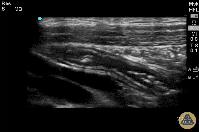 Bedside Ultrasound For Acute Appendicitis - Featuring Colorized Images ...