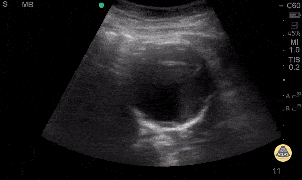 Ruptured Abdominal Aortic Aneurysm Ultrasound
