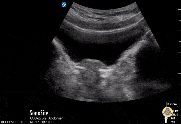 Ovarian Yolk Sac Tumor Ultrasound 7814
