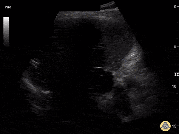 Pneumobilia — TPA