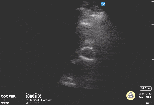 Valvulopathy — TPA