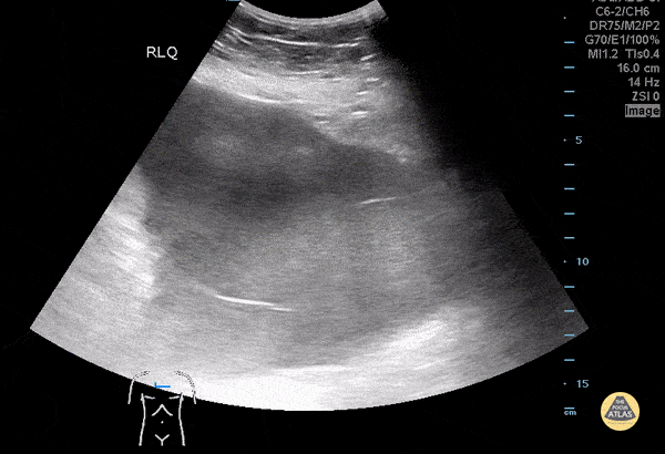 Bowel-GI — TPA
