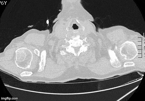 COVID-19 — TPA
