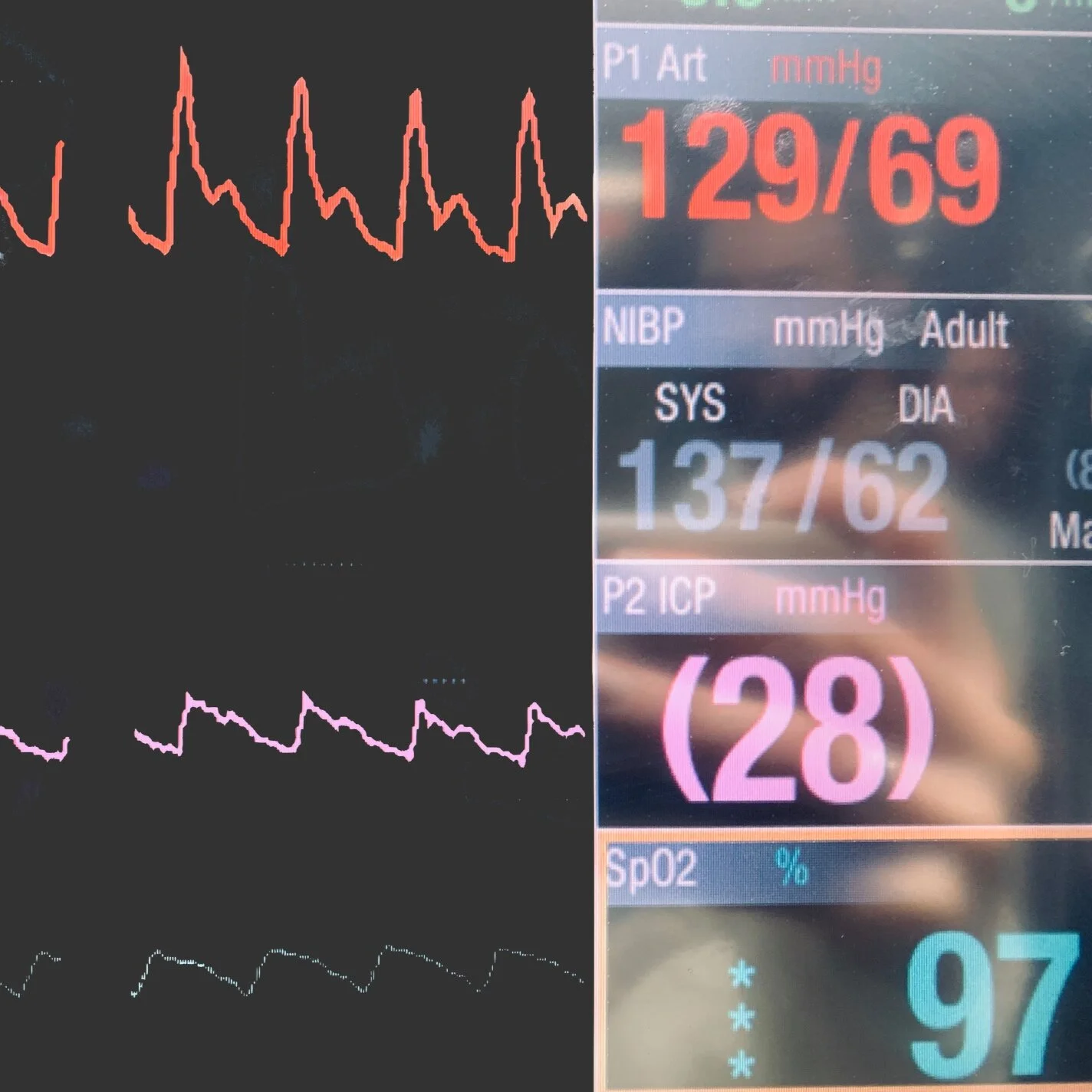 A Neurointensivist’s Approach to POCUS for Increased ICP — TPA