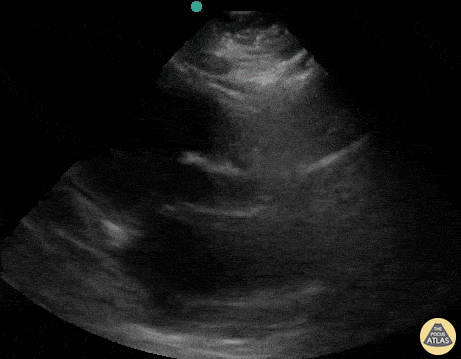 Echocardiography — TPA