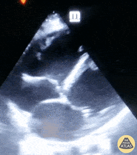 Right Ventricle — TPA