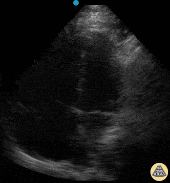 Echocardiography — TPA