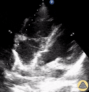 Echocardiography — TPA