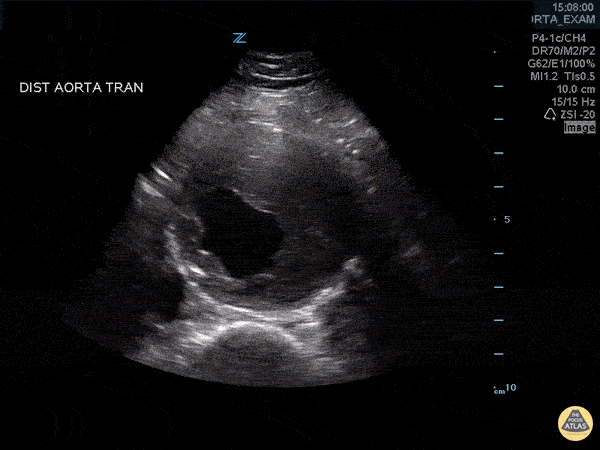 One Minute Image Review - Aorta — TPA