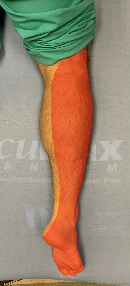 Femoral Nerve Block Distribution
