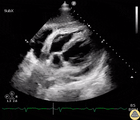 Echocardiography — TPA