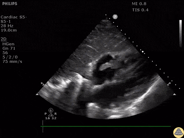 Echocardiography — TPA