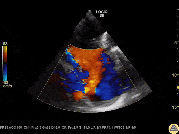 Echocardiography — TPA