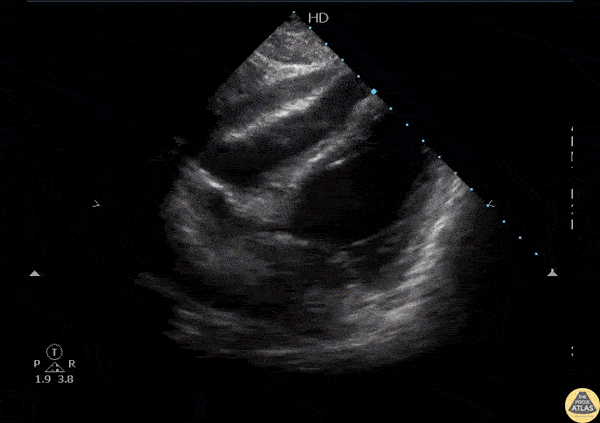 Subxiphoid Pericardial Window