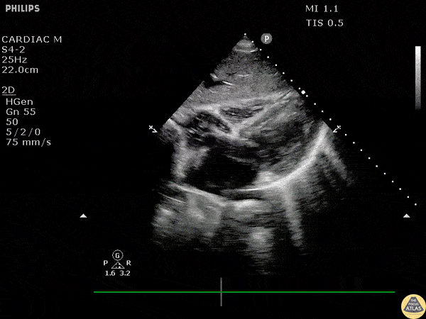 Ventricular Fibrillation Gif