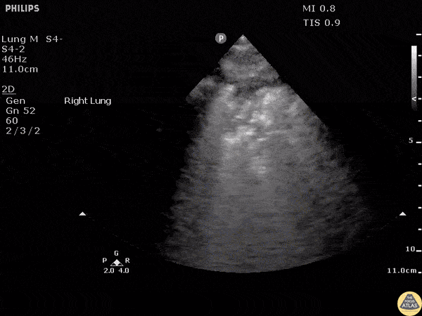 Pulmonary — TPA