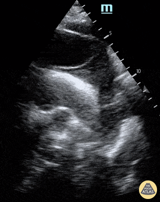 Echocardiography — TPA