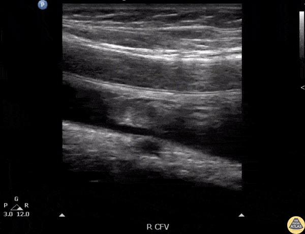 Blood Clot In Leg Ultrasound