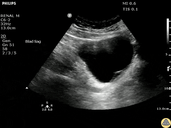 Nephrostomy Tube Ultrasound