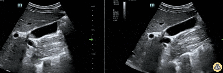 Gallbladder Anatomy Ultrasound