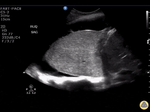 Ascites Vs Pleural Effusion Ultrasound