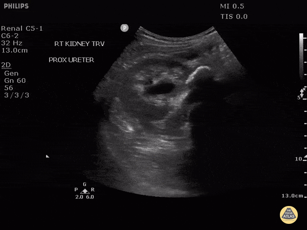 Pyonephrosis Ultrasound