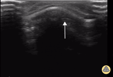 Peds-MSK — TPA