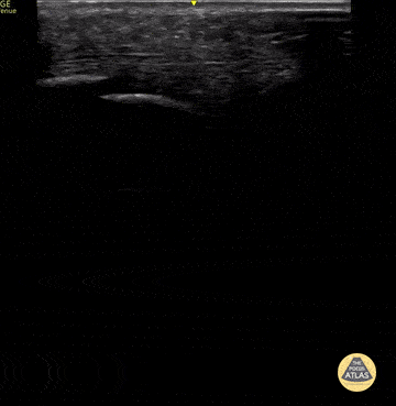 Musculoskeletal Jr — TPA