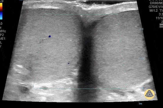 Peds-Genitourinary — TPA