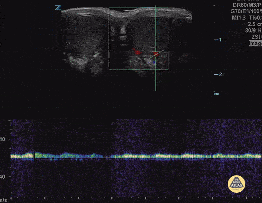 Peds-Genitourinary — TPA