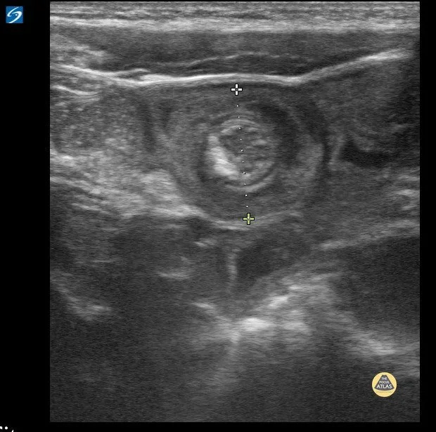 Peds-Gastrointestinal — TPA
