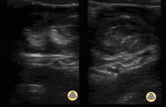 Peds-Gastrointestinal — TPA