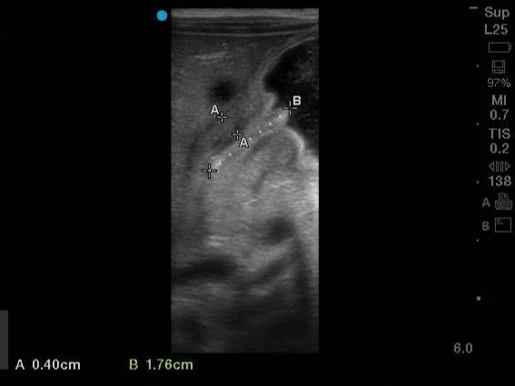 Peds-Gastrointestinal — TPA