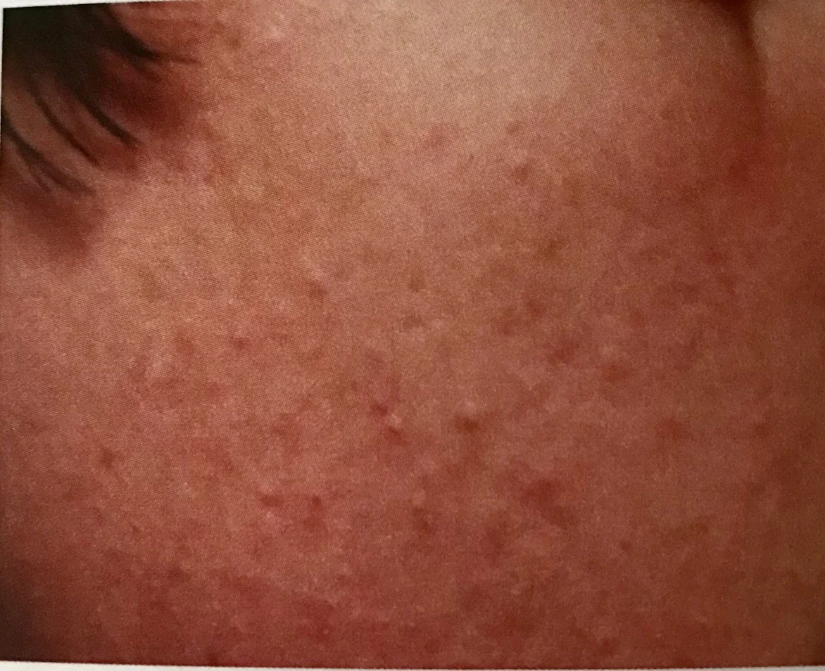 Rosacea On Back