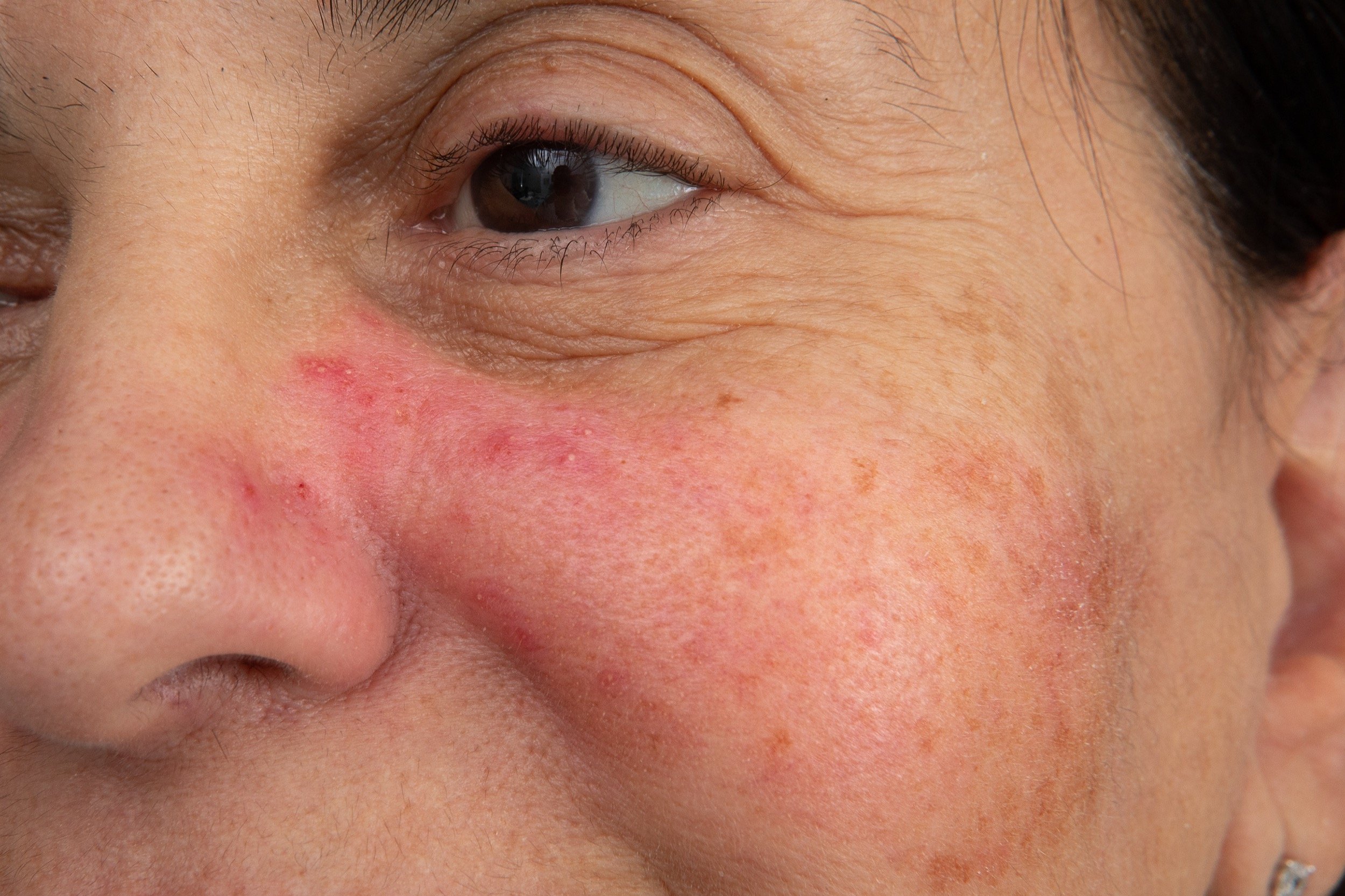 Rosacea Acne
