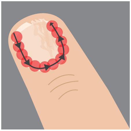 Laser Podiatry Treatments — Trinity Family Medical Clinic