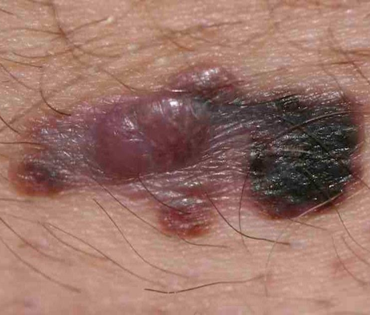 Nodular Melanoma Nodular Melanoma