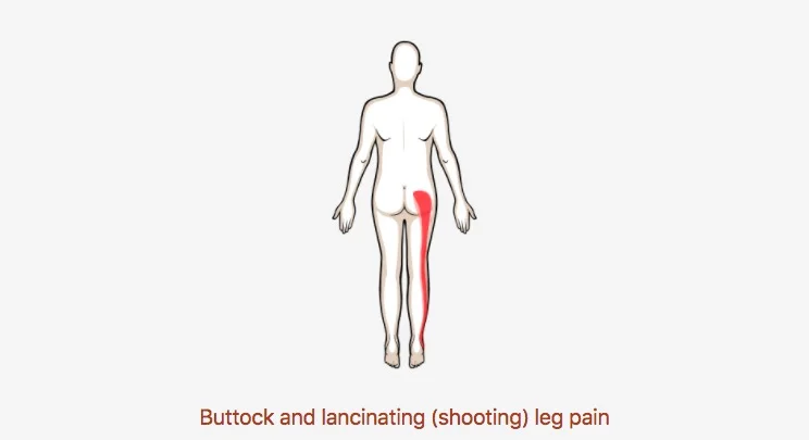 Piriformis Syndrome Pain Pattern