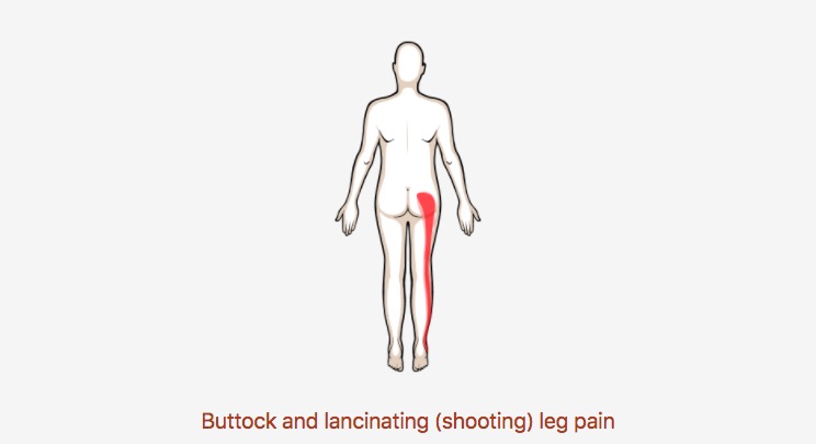 Piriformis Syndrome — Physiou