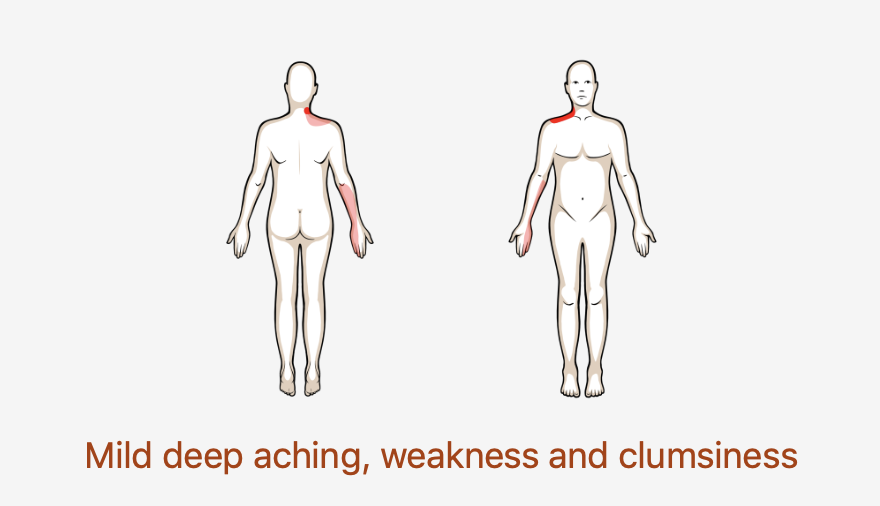 Thoracic Outlet Syndrome Pain Pattern