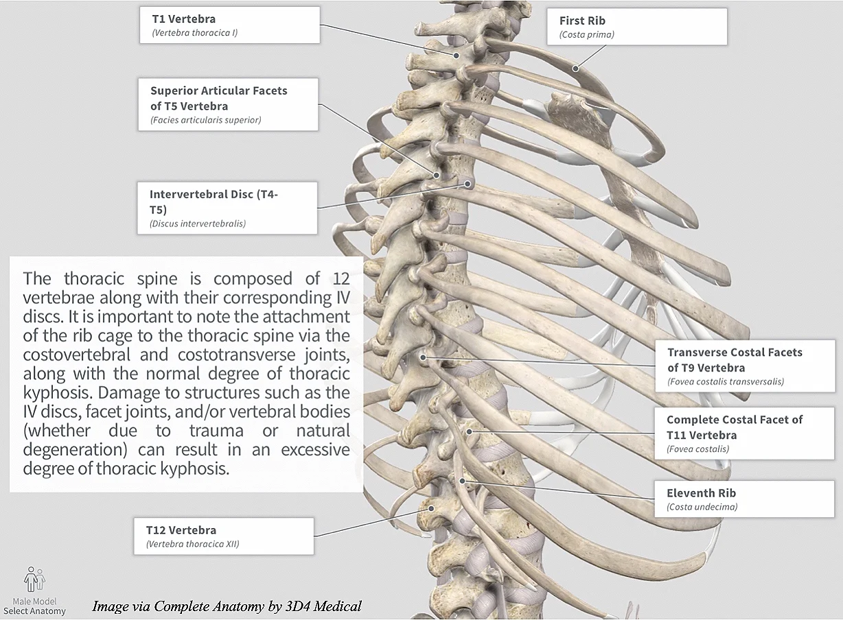 Thoracic Kyphosis/Spondylosis — PhysioU