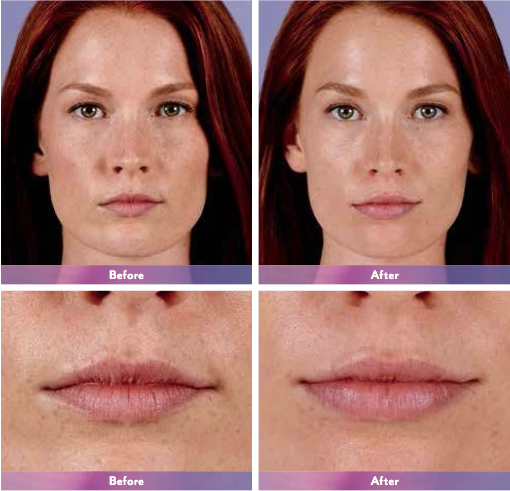 Juvederm Ultra - Lip Fillers in Grand Rapids — Urban You - Modern ...