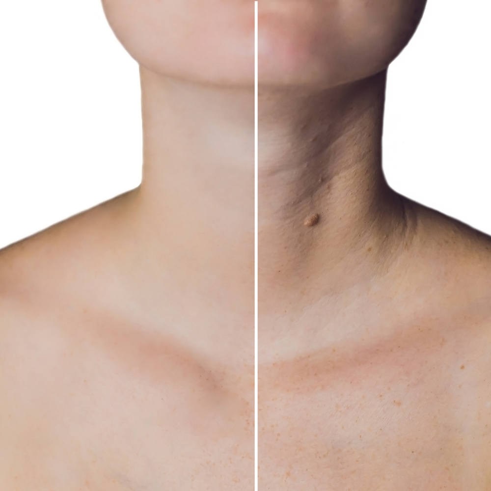 How To Get Rid Of Tech Neck? Micro-Botox is Here to Help! — Urban You ...