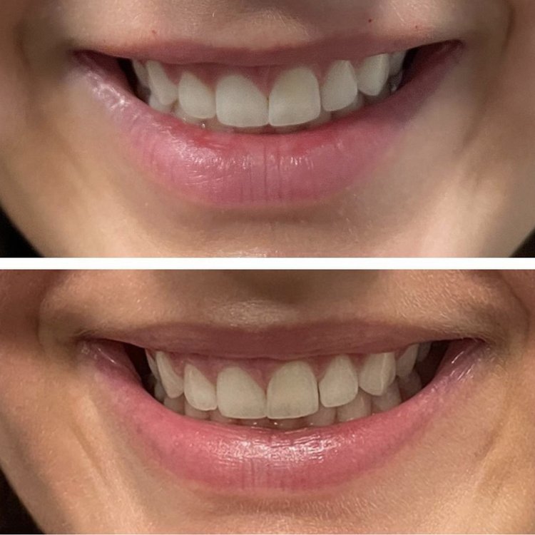 How To Get A Lip Flip With Botox Before And After — Urban You Modern Beauty Wellness